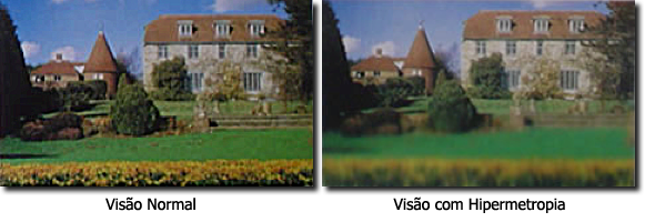 Hipermetropia